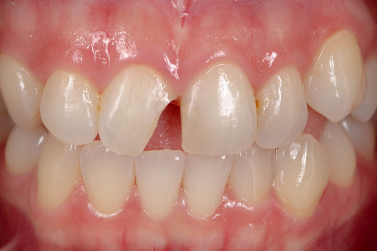 Chipped Tooth: Understanding, Treating, Preventing | Encino Dental Studios