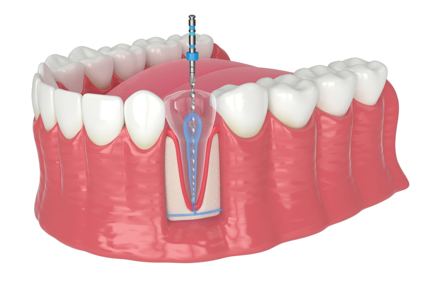 Essential Post Root Canal Care Tips for a Smooth Recovery