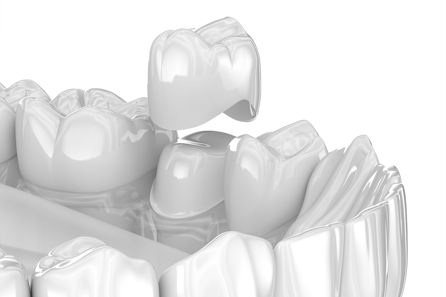 Dental Crowns Archives - Encino Dental Studio