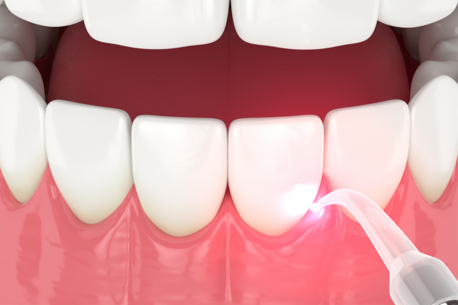 Laser dental treatment at Encino Dental Studio