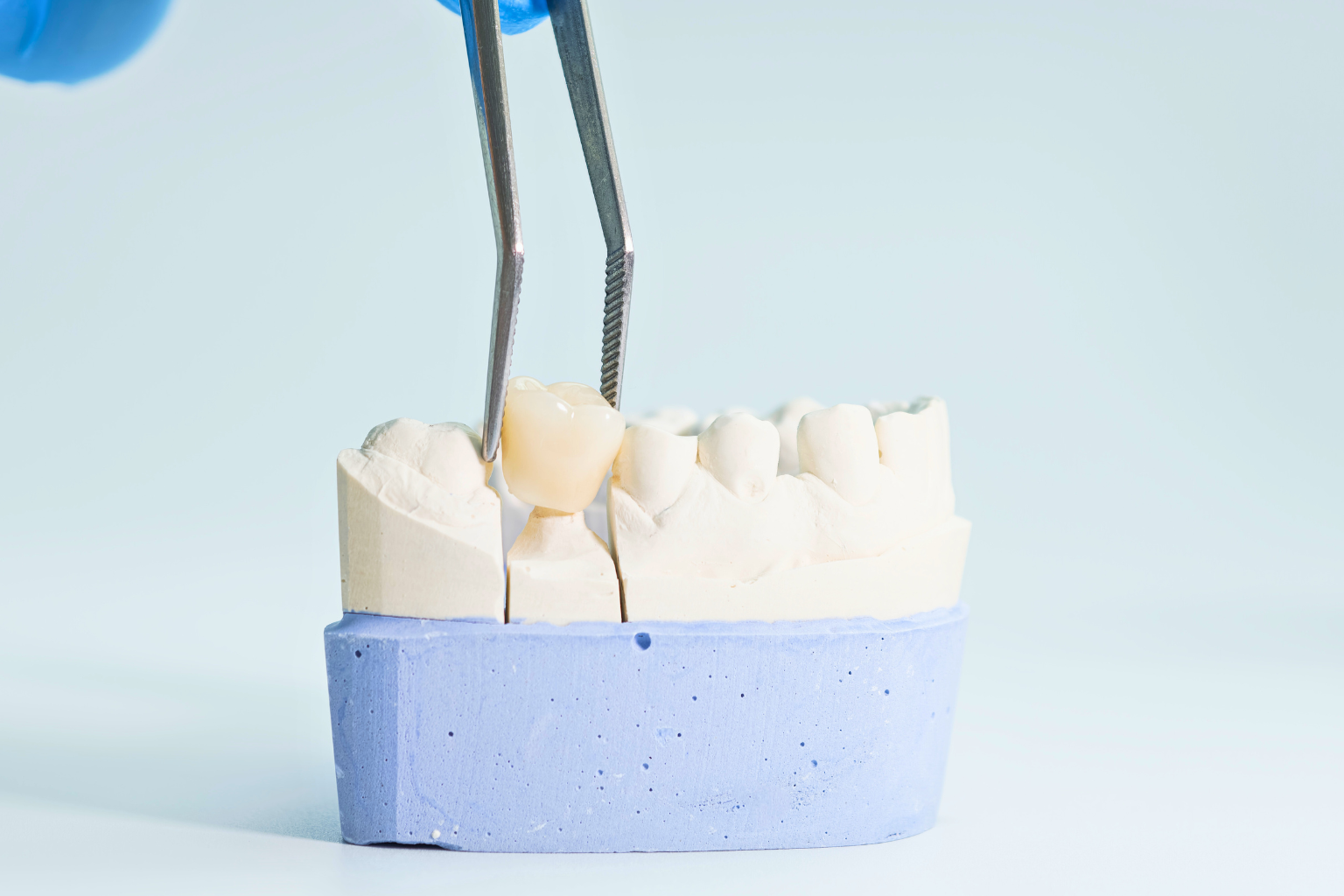 Understanding Dental Crowns with Encino Dental Studio